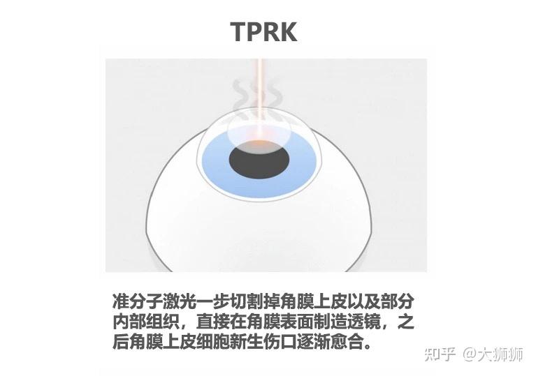 我的近视手术（上篇）为什么我会推荐你首选TPRK，而不是飞秒？ - 知乎
