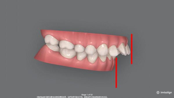 入选Invisalign Global Gallery | Ⅲ度深覆盖+先天缺牙，成人0拔牙前突回收8mm，一年半0骨钉完成！ - 知乎
