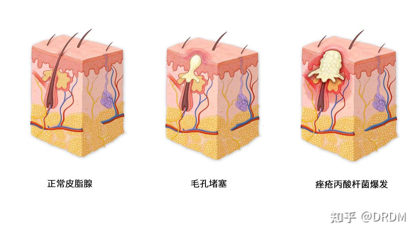 DRDM“六重石斛”精华，祛痘界的新晋“卷王” - 知乎