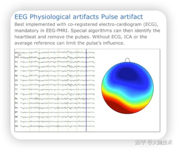 常见EEG伪迹波形图（基于analyzer分析软件展示） - 知乎