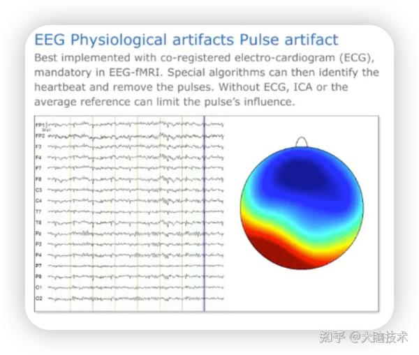 常见EEG伪迹波形图（基于analyzer分析软件展示） - 知乎