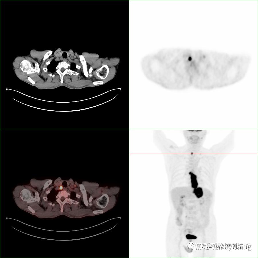 一文通读解析PET-CT检查所有注意事项、放射性危害及典型教学病例一例 - 知乎