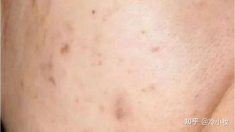 痘肌科学护理，拒绝痘印炎症后色沉！！ - 知乎