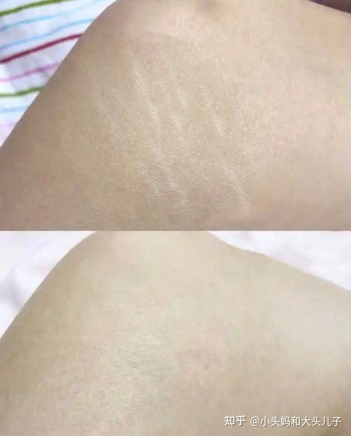年轻人的心头大患【肥胖纹】应如何淡化?瘦了之后肥胖纹能完全消除吗?历经一年多终于淡化肥胖纹,这3个冷知识真的能淡化肥胖纹!