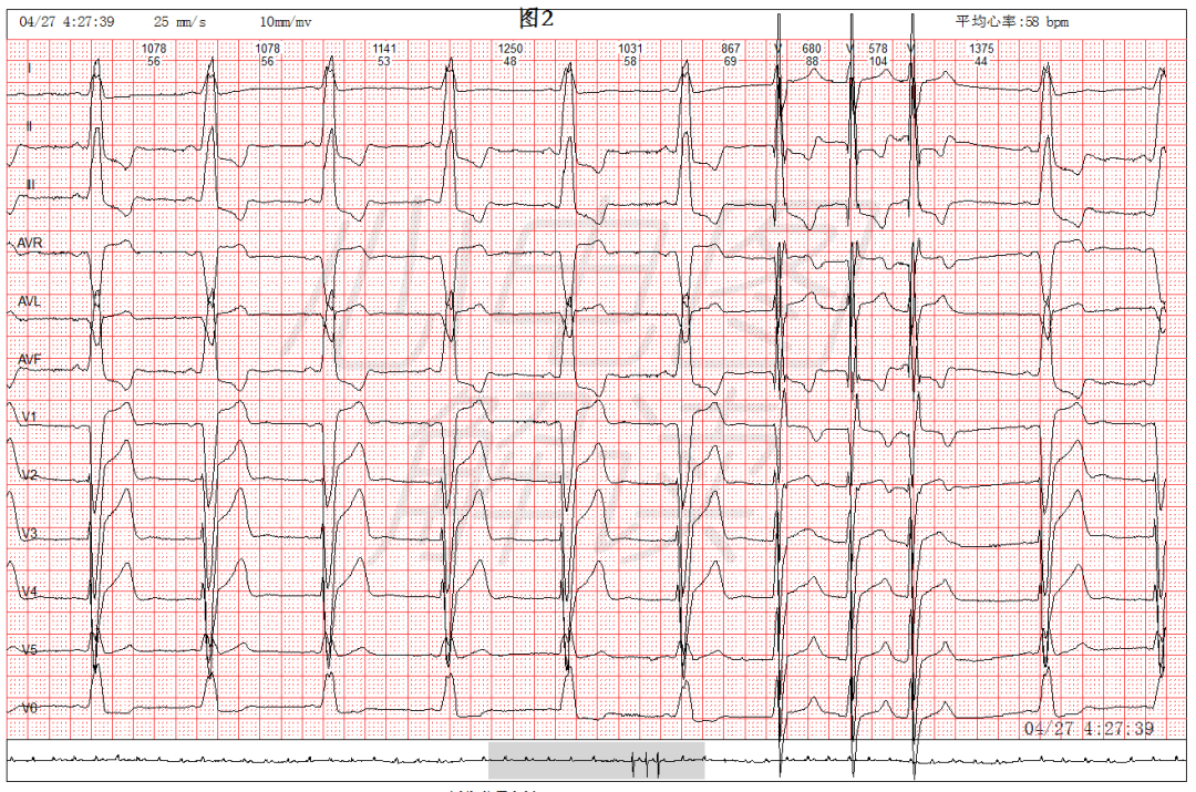 QRS P qrs-p