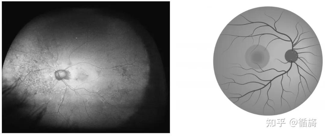 BEST1基因变异引起的黄斑营养不良征-卵黄蛋白病BVMD、AVMD、ARB、ADVIRC、RP - 知乎