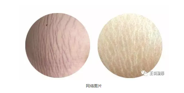 如果错过生长纹肥胖纹妊娠纹的最佳治疗时机,难看的乳房肚皮大腿就真的要陪你一辈子了 知乎