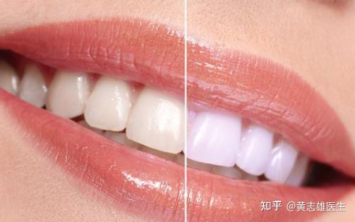 冷光美白效果怎么样?冷光美白对牙齿有什么伤害? 知乎
