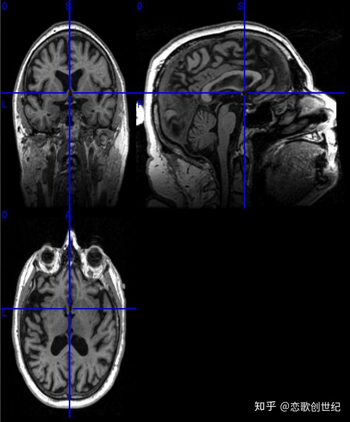 MRI图像的预处理流程 - 知乎