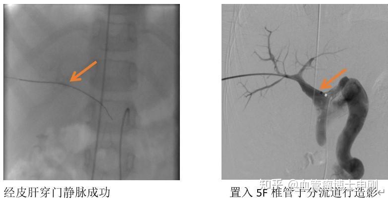 Abernethy畸形介入栓塞治疗病例 - 知乎