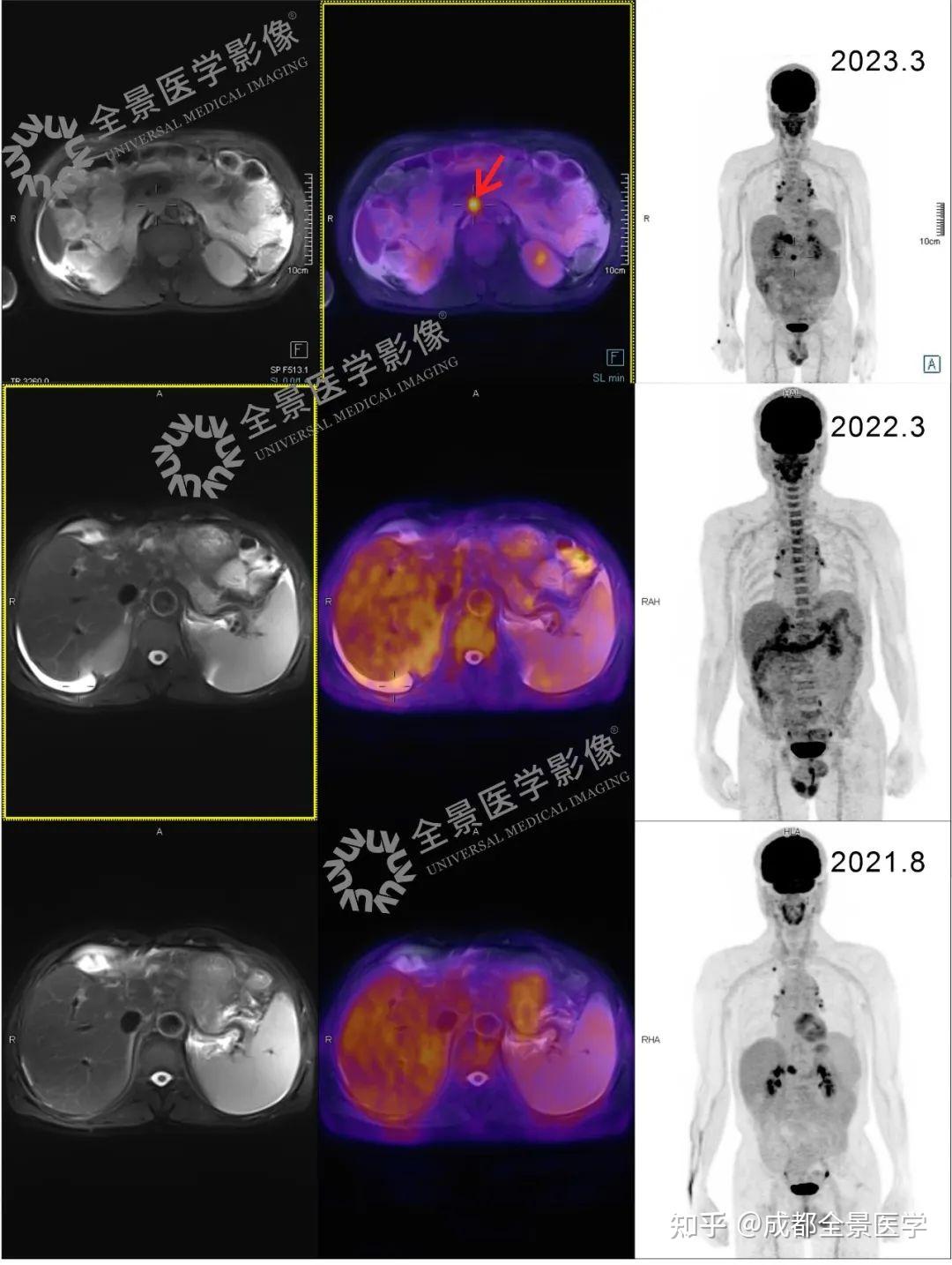 肿瘤追踪，PET/CT-MR显神通！ - 知乎