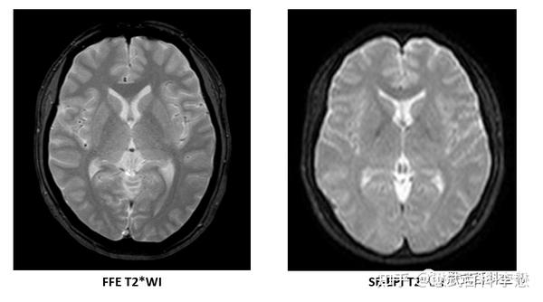 磁共振序列之T2*WI - 知乎