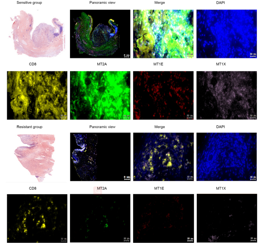 项目文章| 外周血单细胞图谱揭示食管鳞癌患者PD-1耐药机制 - 知乎