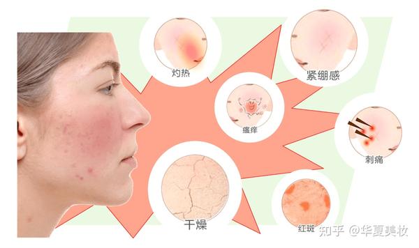 为什么会变成敏感肌? 知乎
