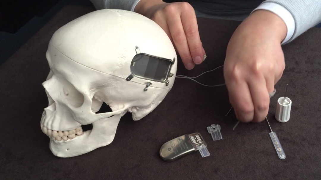 MedTech | NeuroPace开启RNS系统新研究 - 知乎