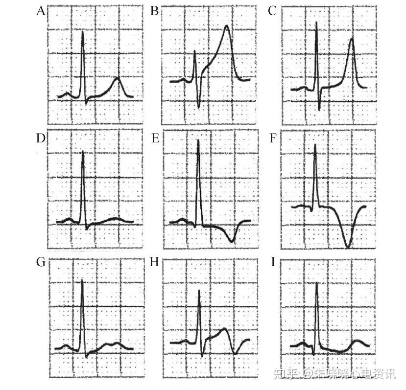 规范的心电图参数测量，你掌握了吗？ - 知乎