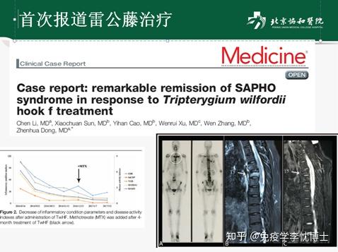 SAPHO综合征有哪些治疗方法？ - 知乎