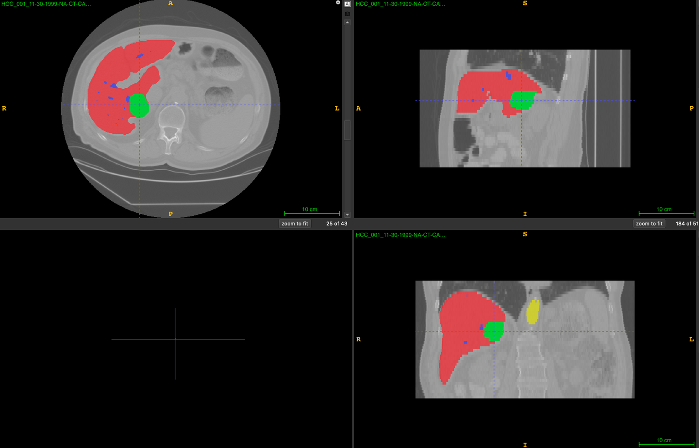 HCC-TACE-Seg 数据集介绍 - 知乎