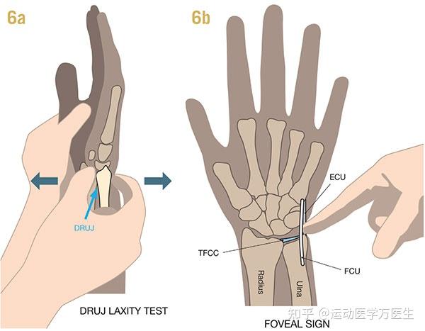 运动后手腕疼？可能里面的小软骨（TFCC）破了 - 知乎