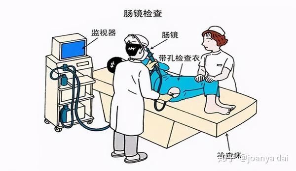 结直肠癌的结肠镜检查前需要清洁肠道?结肠镜检查需要注意哪些事 知乎