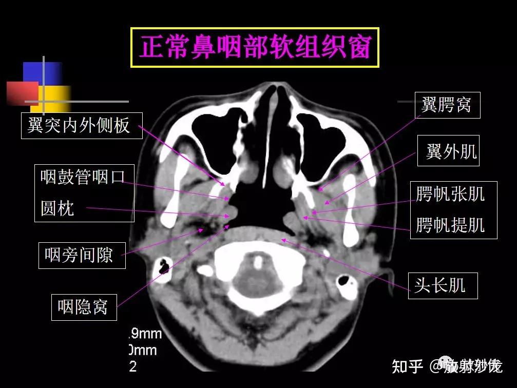 收藏必备 鼻咽部的ct详细解剖 知乎