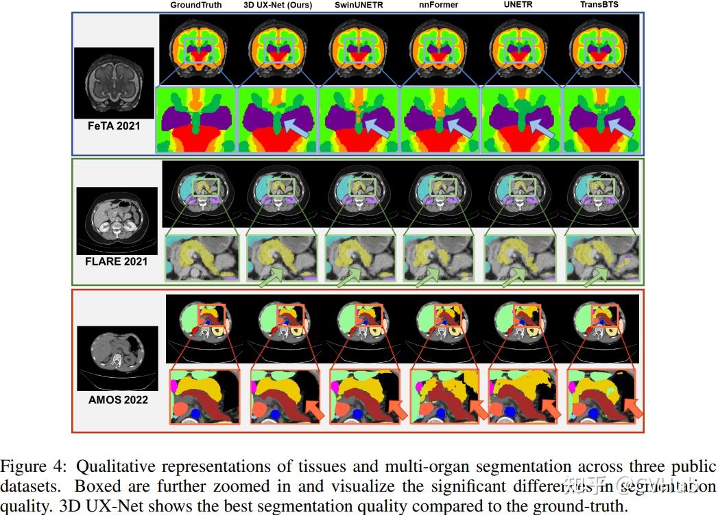 集简单、高效、轻量化于一体 | ICLR 2023 新鲜出炉医学图像分割之王: 3D UX-NET - 知乎
