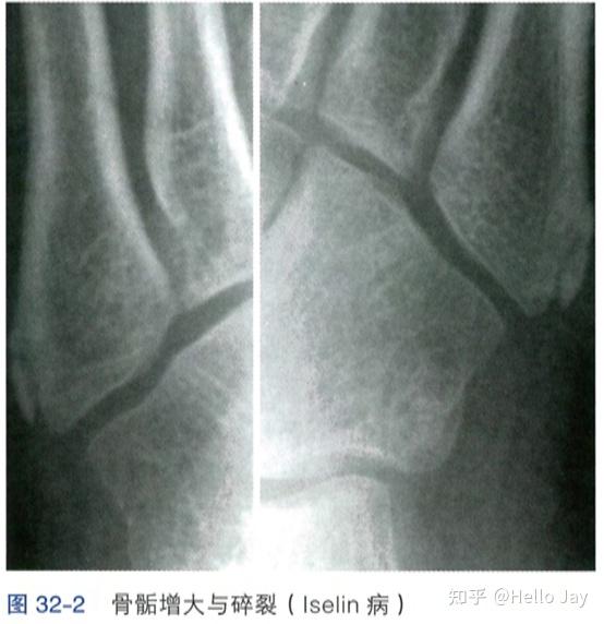 第五跖骨基底牵拉性骨骺炎（Iselin病） - 知乎