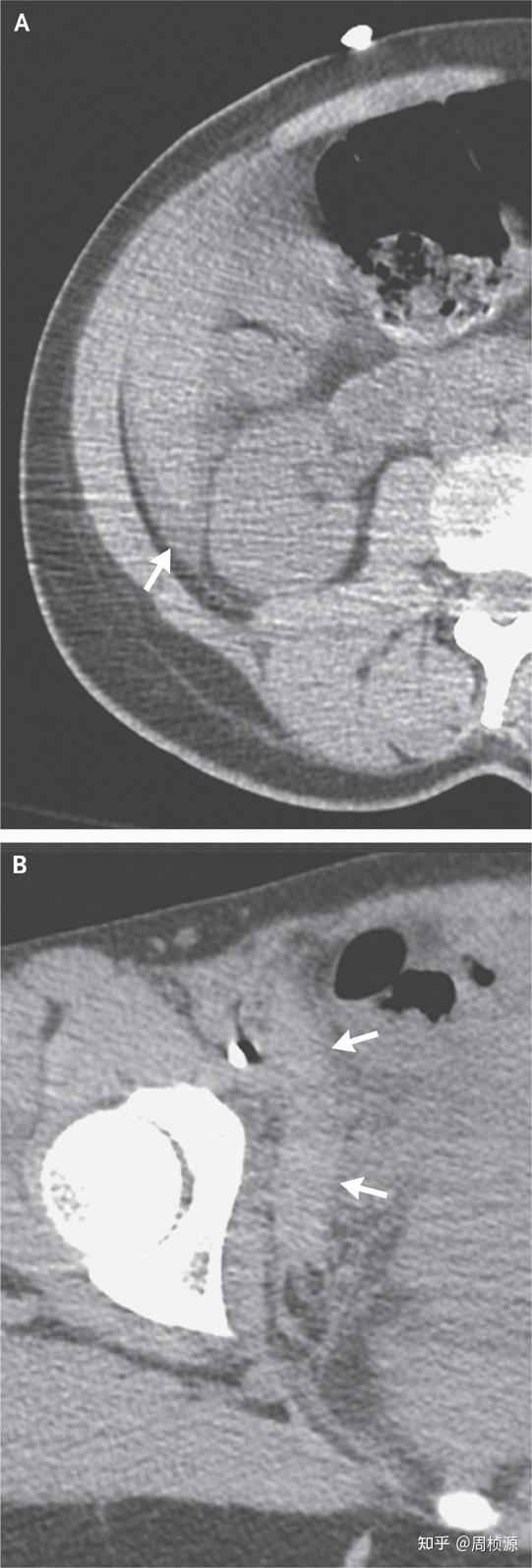 Nejm 2011 Case 2 - 知乎