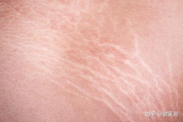 大腿和臀部都出现白色的肥胖纹要怎么去除 知乎