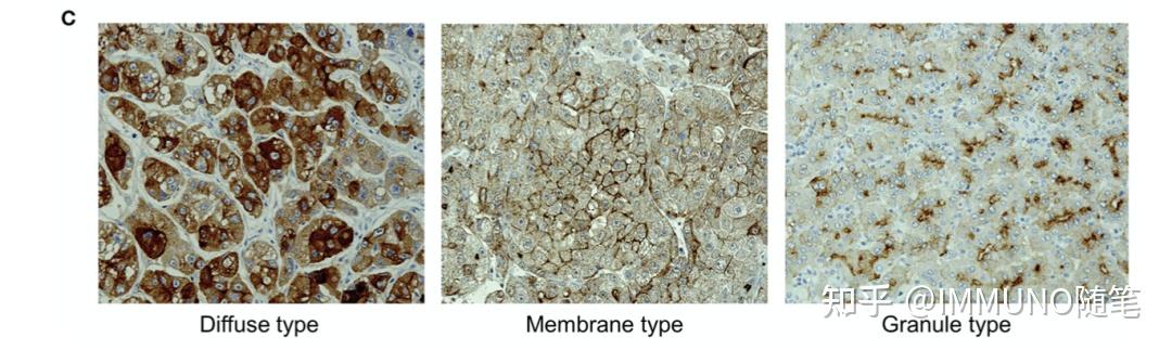 GPC3，肿瘤免疫治疗热门靶点 - 知乎