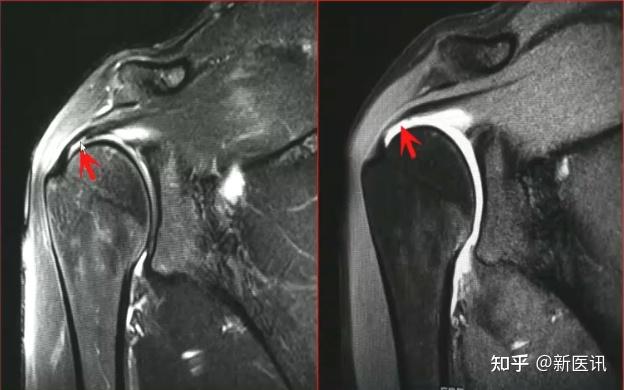 肩袖部分撕裂(partial RCT)、肩袖完全撕裂(complete RCT) - 知乎
