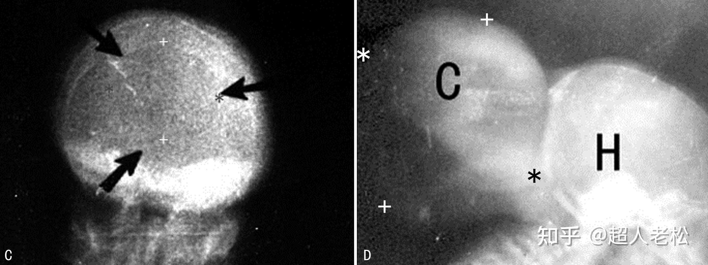 明明白白做超声25-9：胎儿神经管缺陷—脑膨出 - 知乎