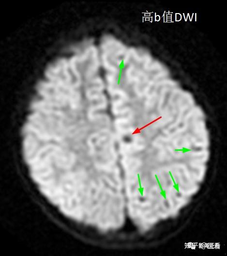 一个颅脑病例，带大家重新认识DWI序列 - 知乎
