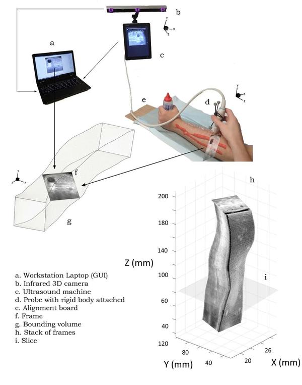 【Simpleware】利用自由式三维超声无创监测动静脉瘘 - 知乎