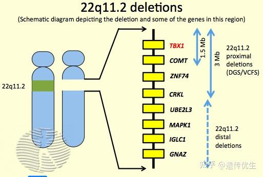22号染色体上的微缺失—22q11.2的微缺失综合征（DiGeorge综合征） - 知乎