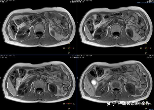 磁共振肾脏规范化扫描及临床应用（一） - 知乎