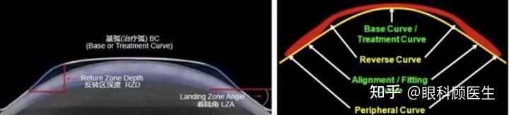 各类不同品牌的OK镜汇总及选择 - 知乎