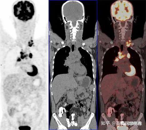 18F-FDG是什么？18F-FDG怎么标记病灶【高尚医学影像】 - 知乎