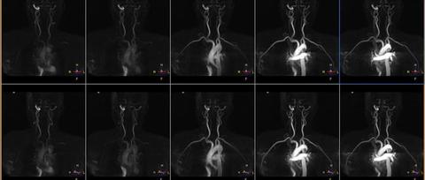 4D-Flow扫描数据采集：序列及参数 - 知乎
