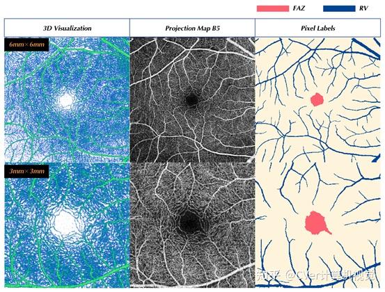 80GB 医学影像数据集发布！OCTA-500公开下载 - 知乎