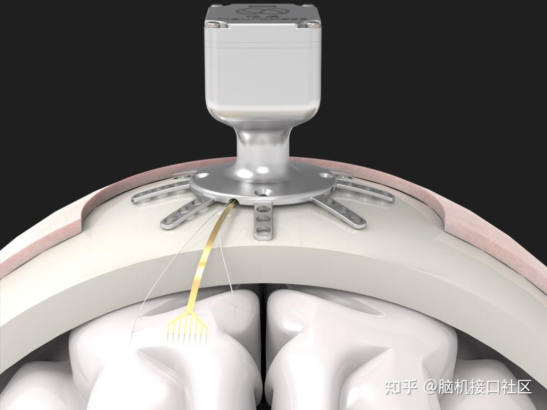 脑虎科技NeuroXess完成数亿元A轮融资，持续推进侵入式脑机接口发展 - 知乎