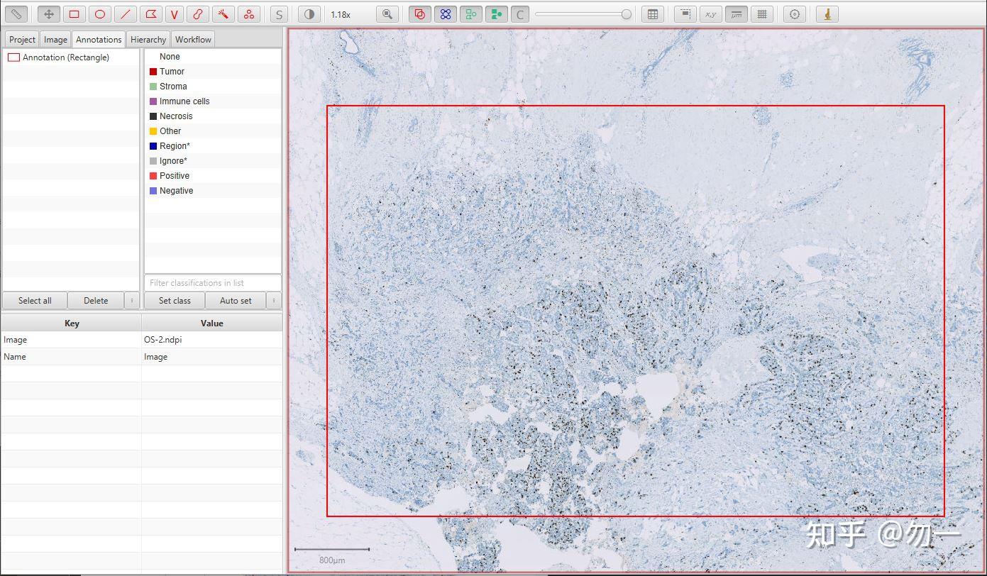[数字病理]使用QuPath检测IHC阳性肿瘤细胞百分比 - 知乎