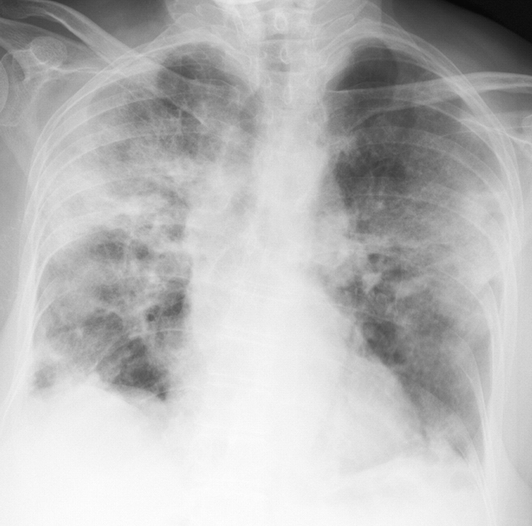 CoronaHack -Chest X-Ray 数据集介绍 - 知乎