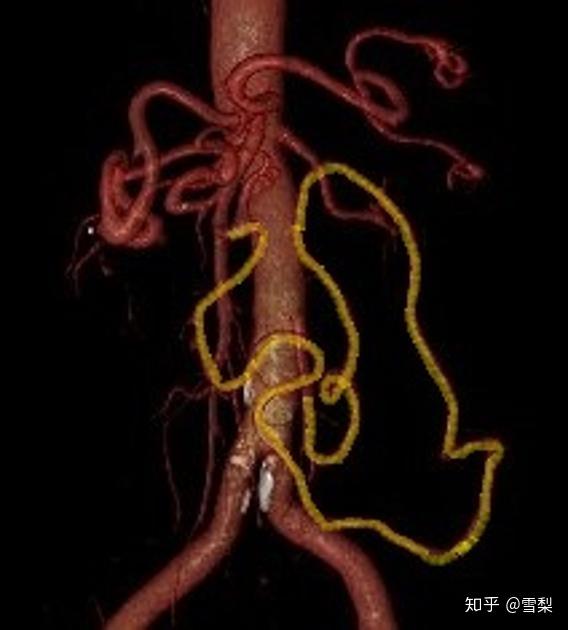 Marginal artery of Drummond - 知乎