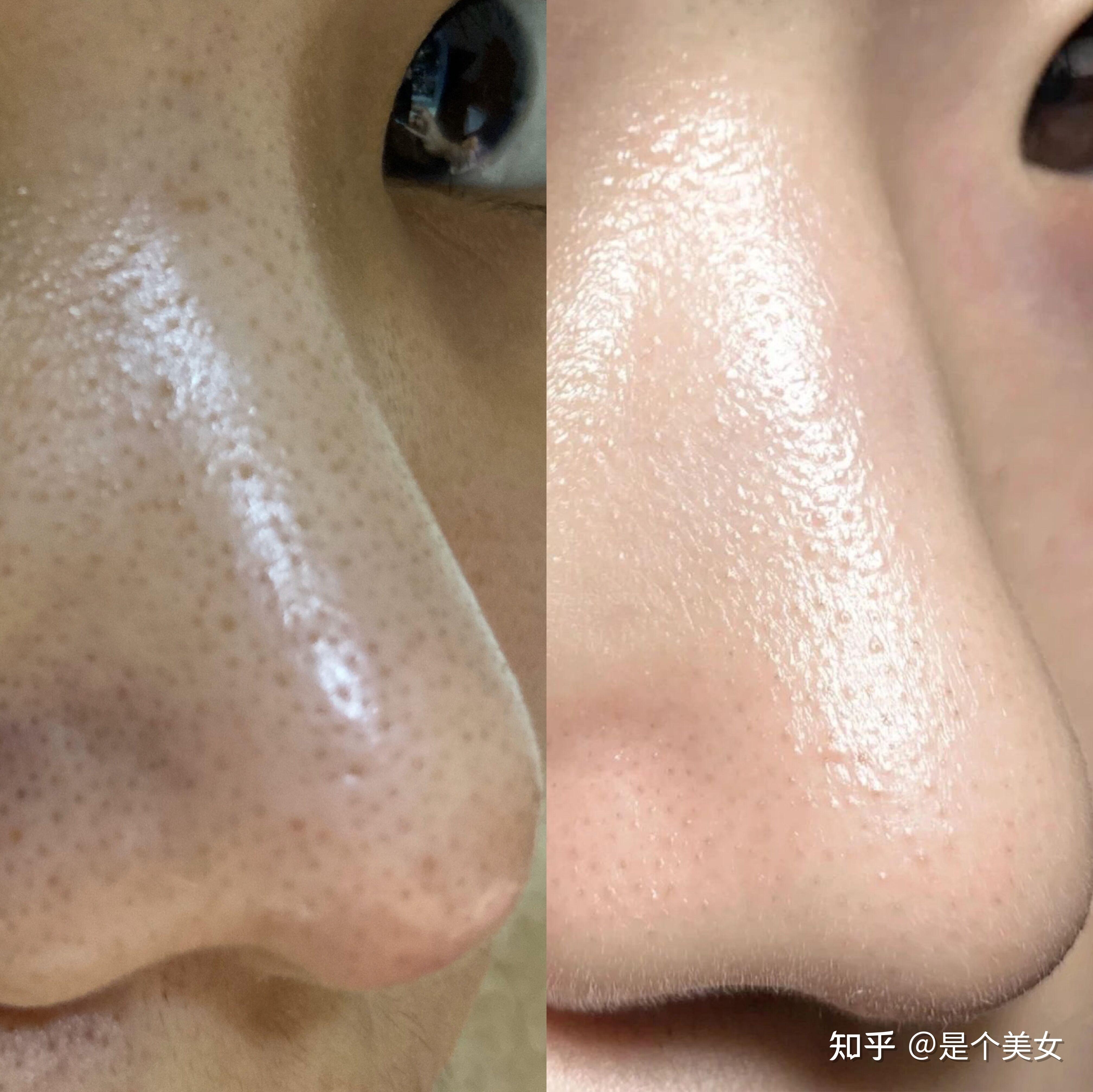为什么那么多知友都在推荐祛黑头用乳糖酸?乳糖酸祛黑头效果真的那么好吗? 知乎