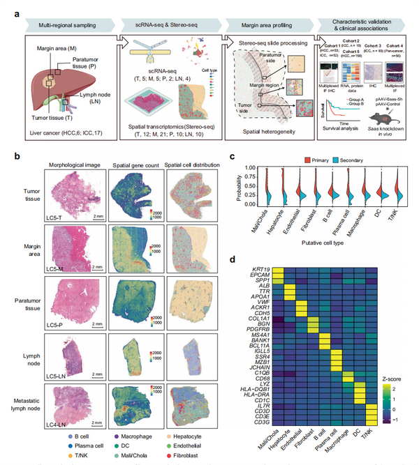 Cell Res | Stereo-seq揭示人类肝癌浸润区促进肝细胞-肿瘤细胞串扰、局部免疫抑制和肿瘤进展 - 知乎
