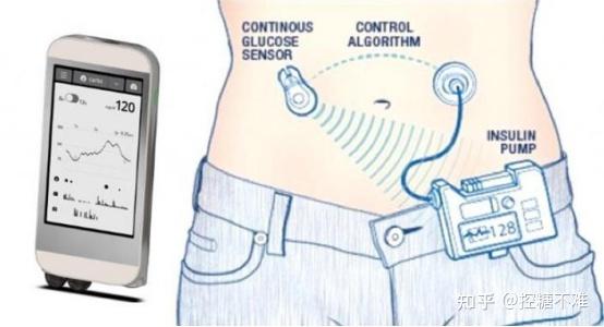 【美敦力722】Loop闭环胰岛素泵系统搭建 - 知乎