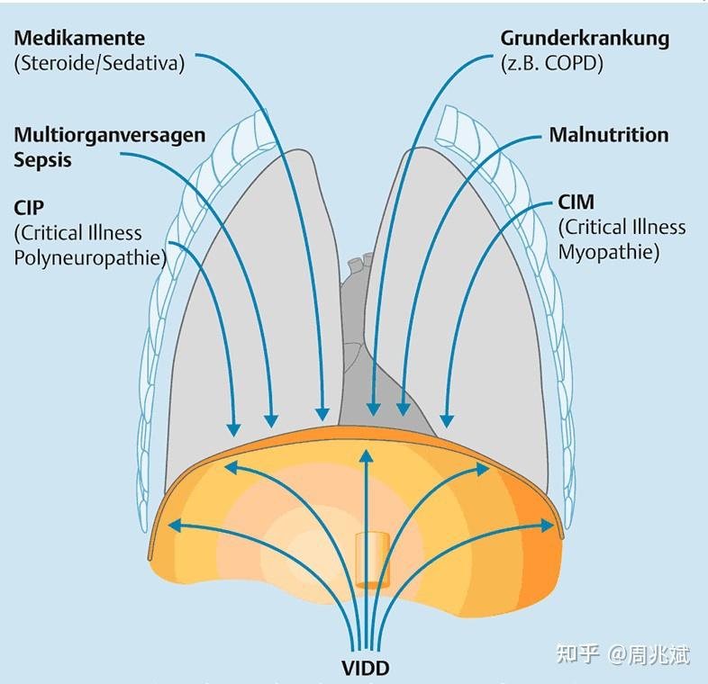 怎么去防治呼吸机所致膈肌功能障碍(ventilator-induced diaphragmatic dysfunction，VIDD) - 知乎
