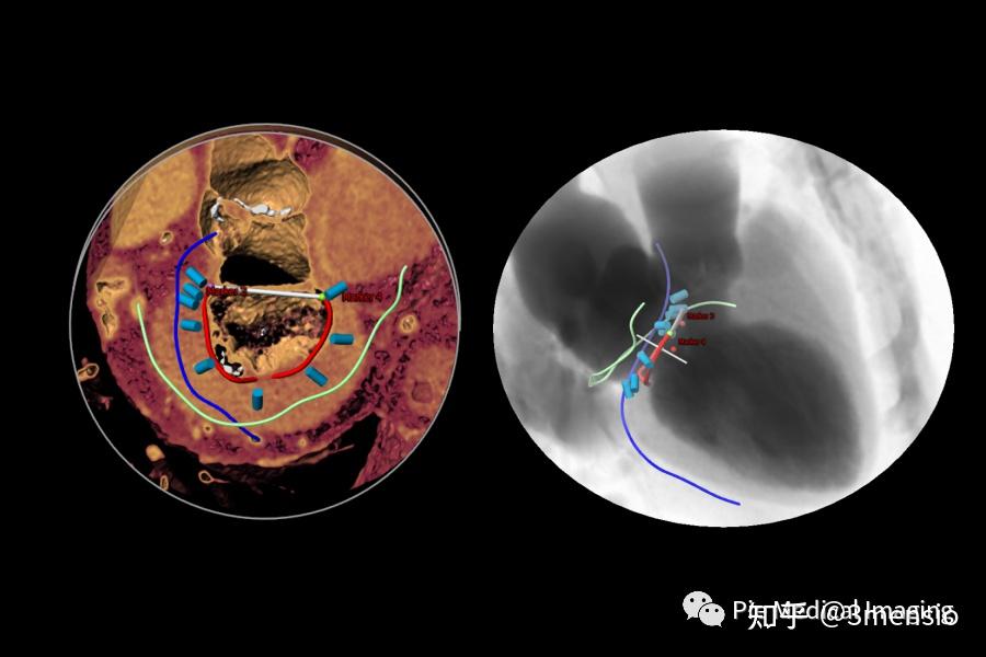 3mensio Mitral - 知乎