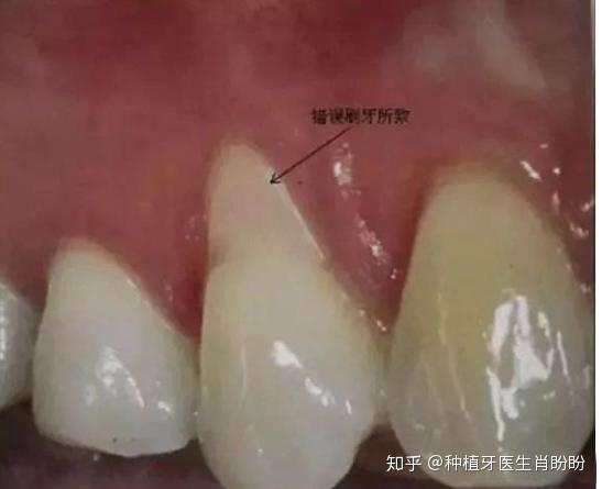 牙龈萎缩了才知道,原来是我一直不会刷牙后悔莫及了! 知乎
